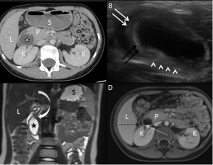 Duplication cyst Treatment | Paediatric duplication cyst treatment